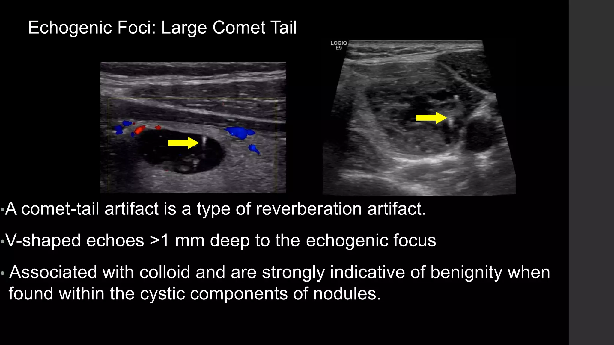 thyroid imaging reporting & data system | PPTX