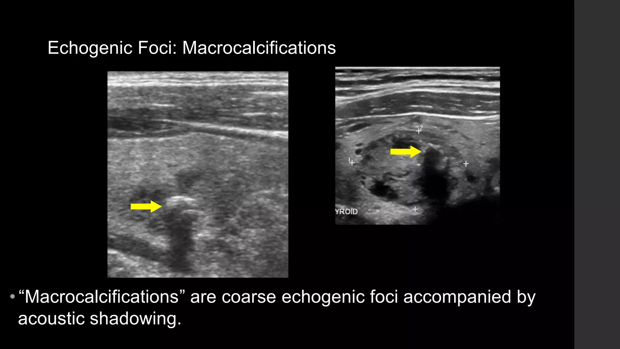 thyroid imaging reporting & data system | PPTX