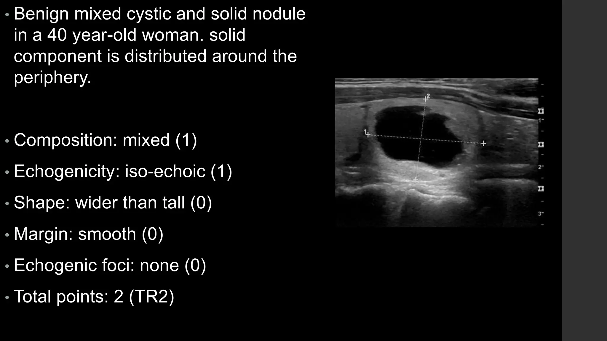 Thyroid Imaging Reporting And Data System Pptx