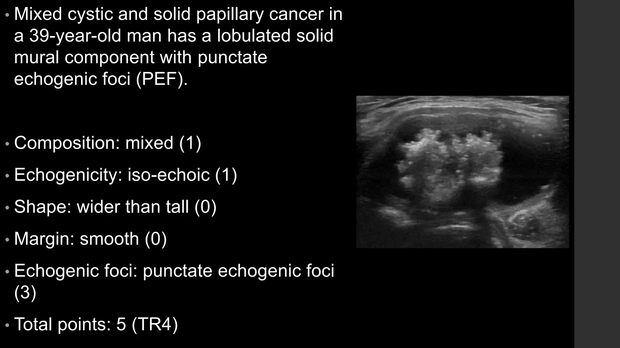 thyroid imaging reporting & data system | PPTX