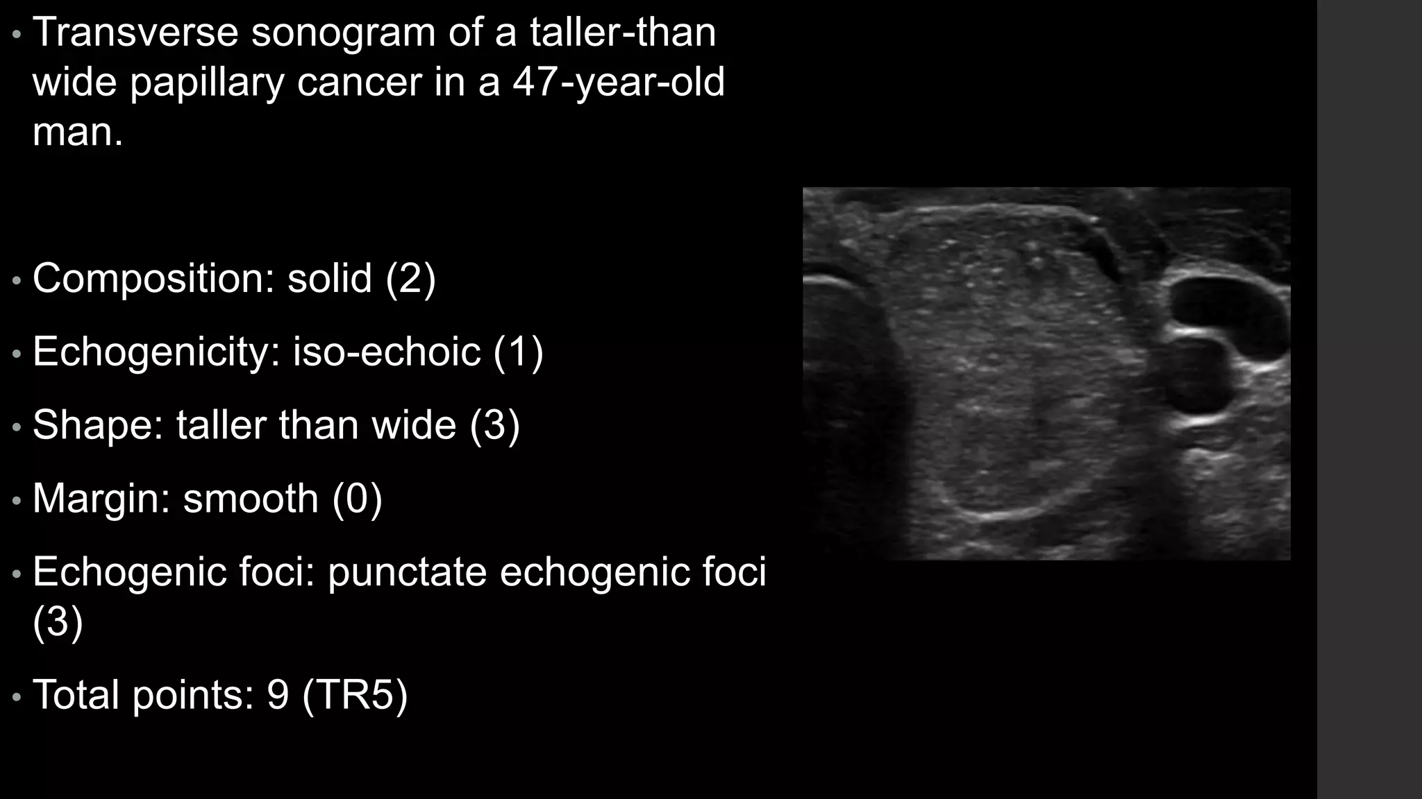 thyroid imaging reporting & data system | PPTX
