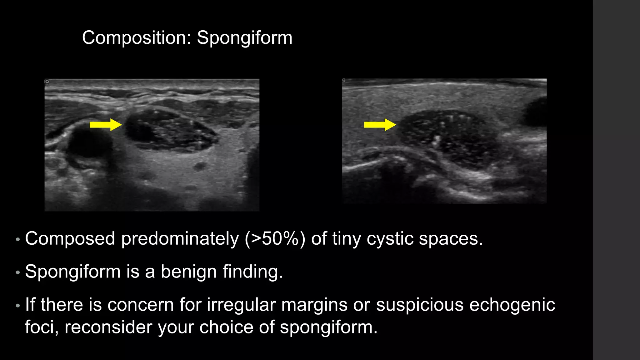 Thyroid Imaging Reporting And Data System Pptx