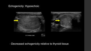 thyroid imaging reporting & data system | PPTX