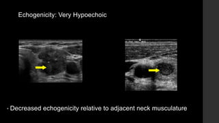 thyroid imaging reporting & data system | PPTX
