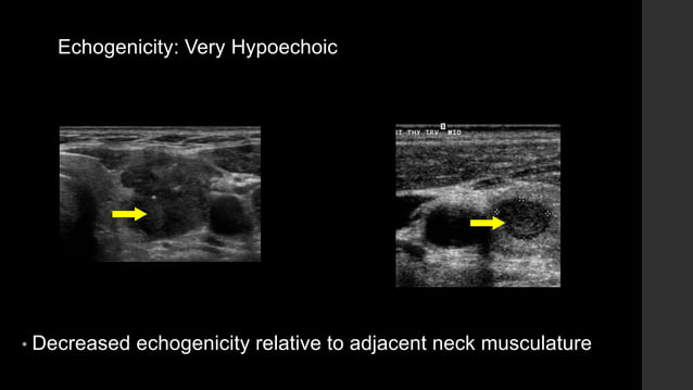 thyroid imaging reporting & data system | PPTX