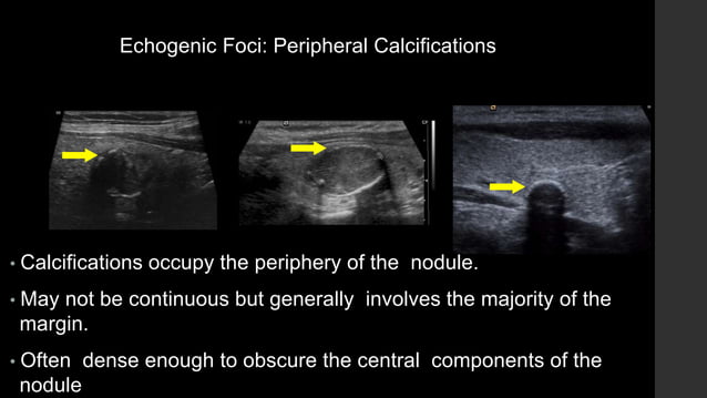 Thyroid Imaging Reporting And Data System Pptx