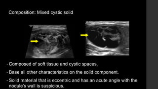 thyroid imaging reporting & data system | PPTX
