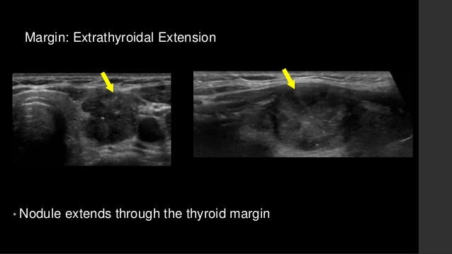 thyroid imaging reporting & data system