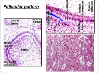 Lesions of oral cavity and salivary gland. | PPTX
