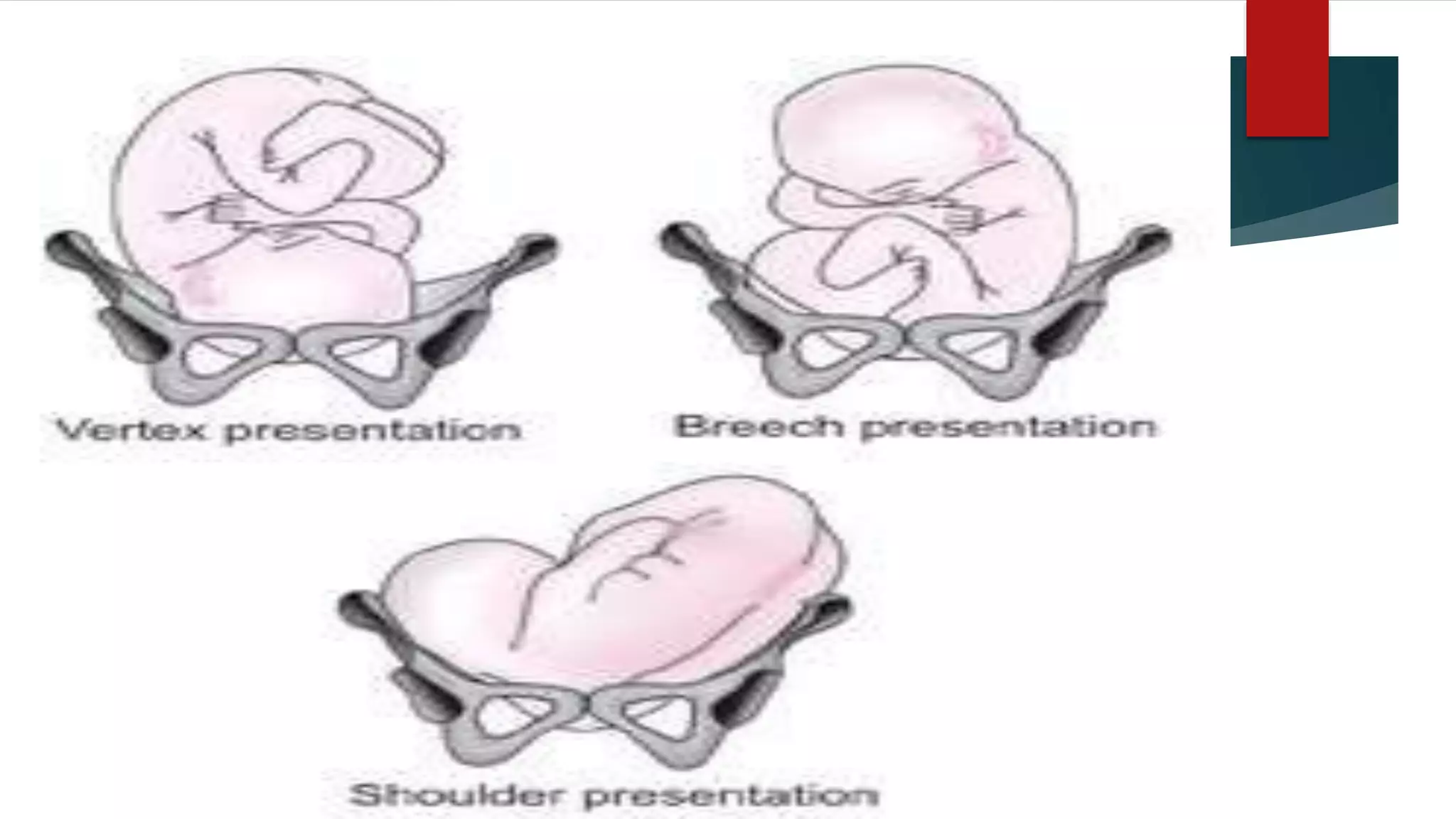 OBSTRUCTED LABOR | PPTX