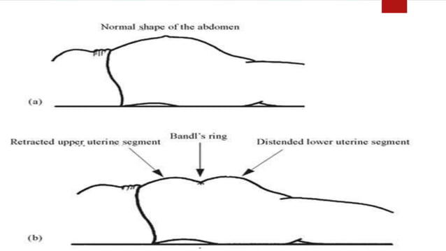 OBSTRUCTED LABOR | PPT