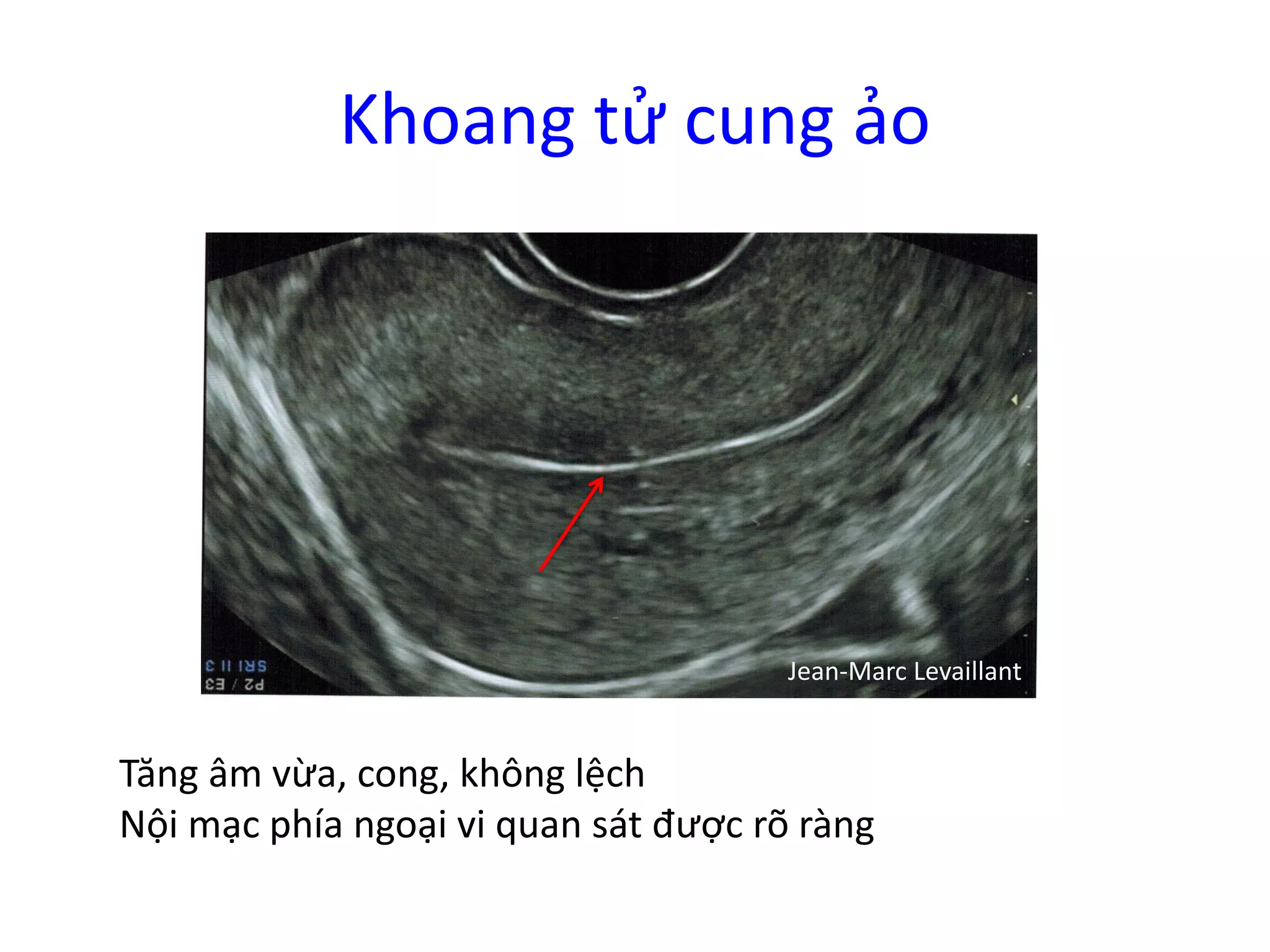1. Sieu am phu khoa binh thuong, GS Michel Collet | PDF