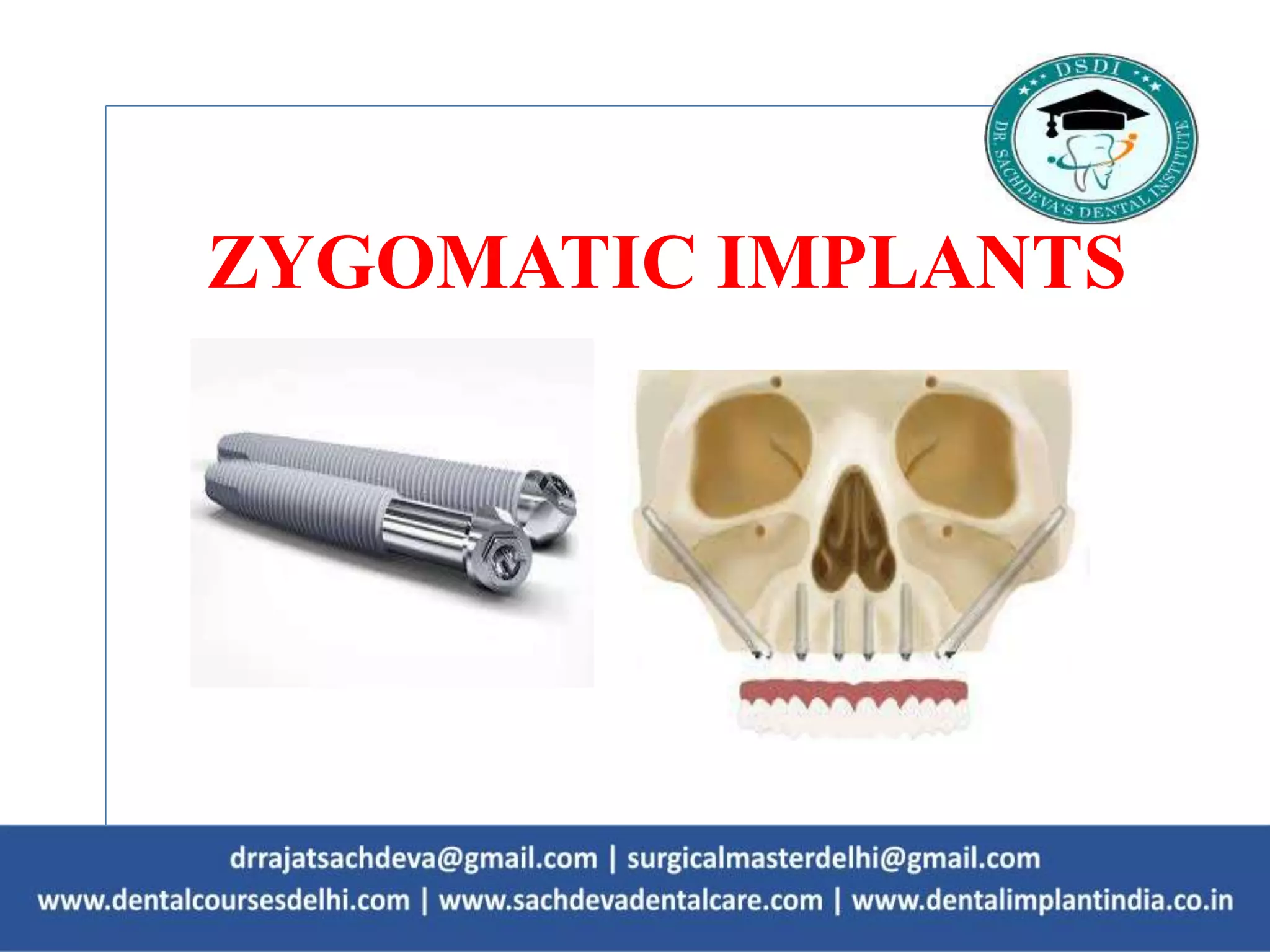 Zygomatic implants | PPTX