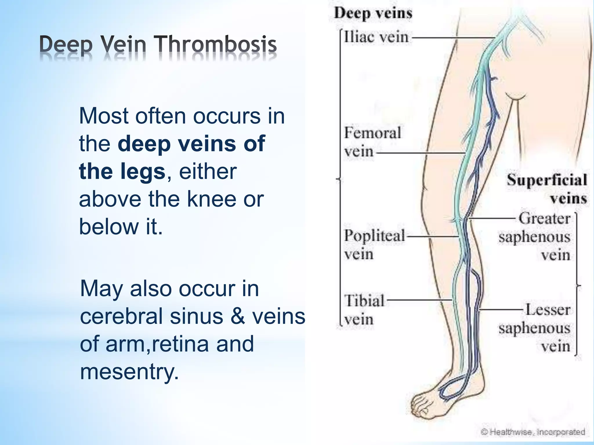 Deep Vein Thrombosis (dvt) by Dr Aftub | PPT