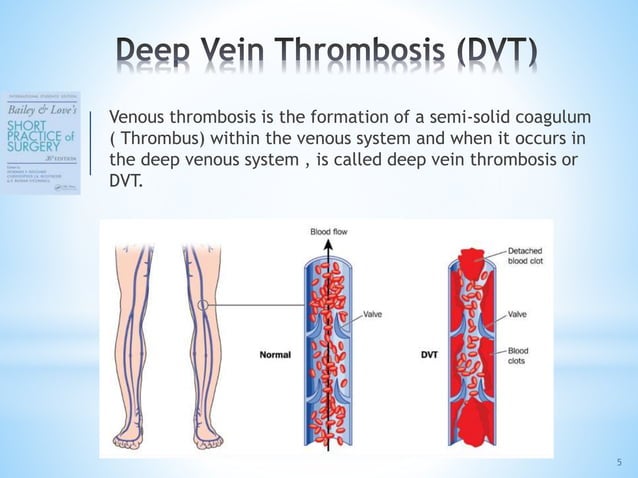 Deep Vein Thrombosis (dvt) by Dr Aftub | PPT
