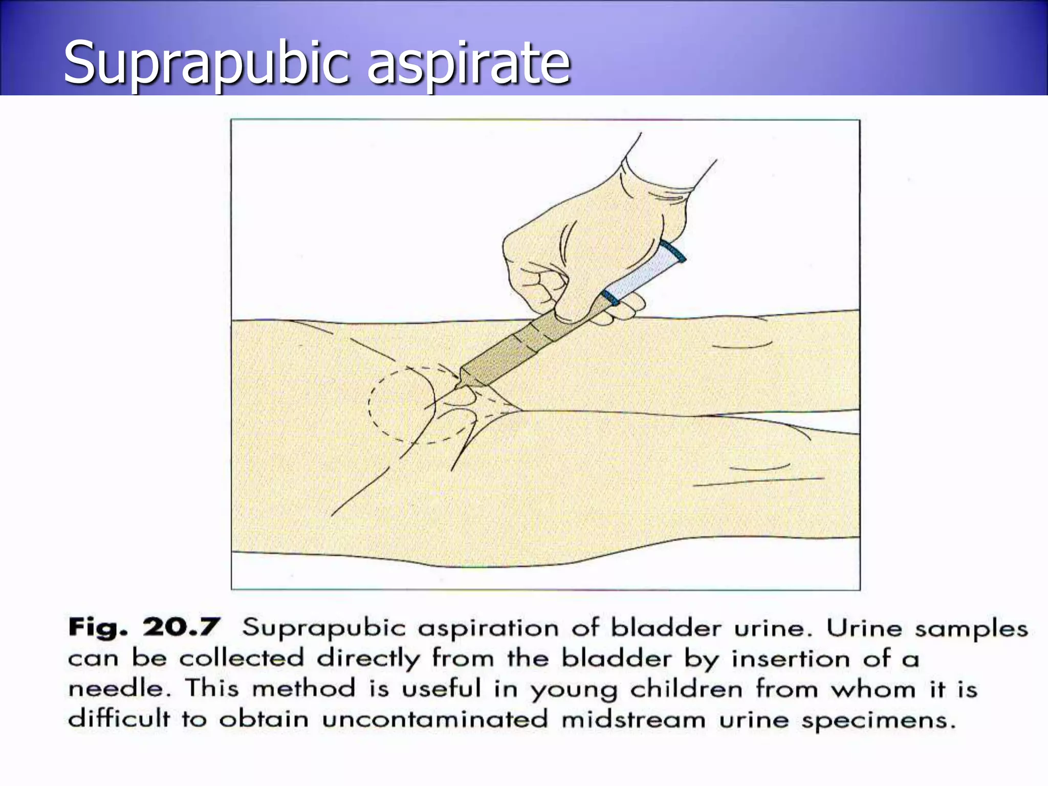 1. urinary tract infection (UTI) | PPT