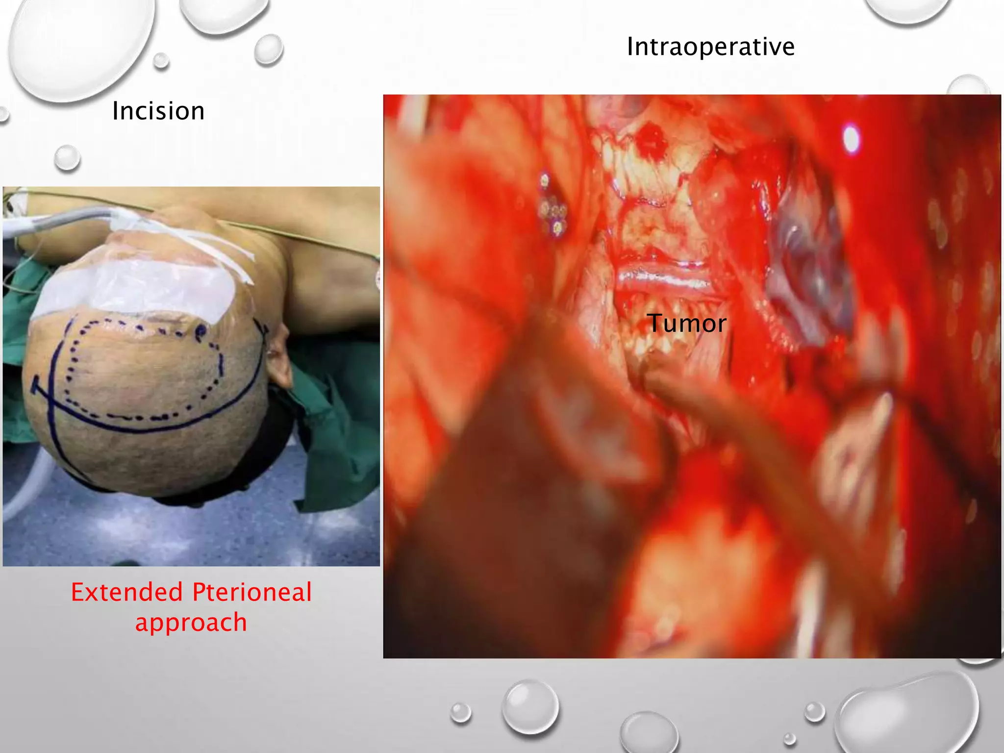 Craniopharyngioma: A case report | PPTX