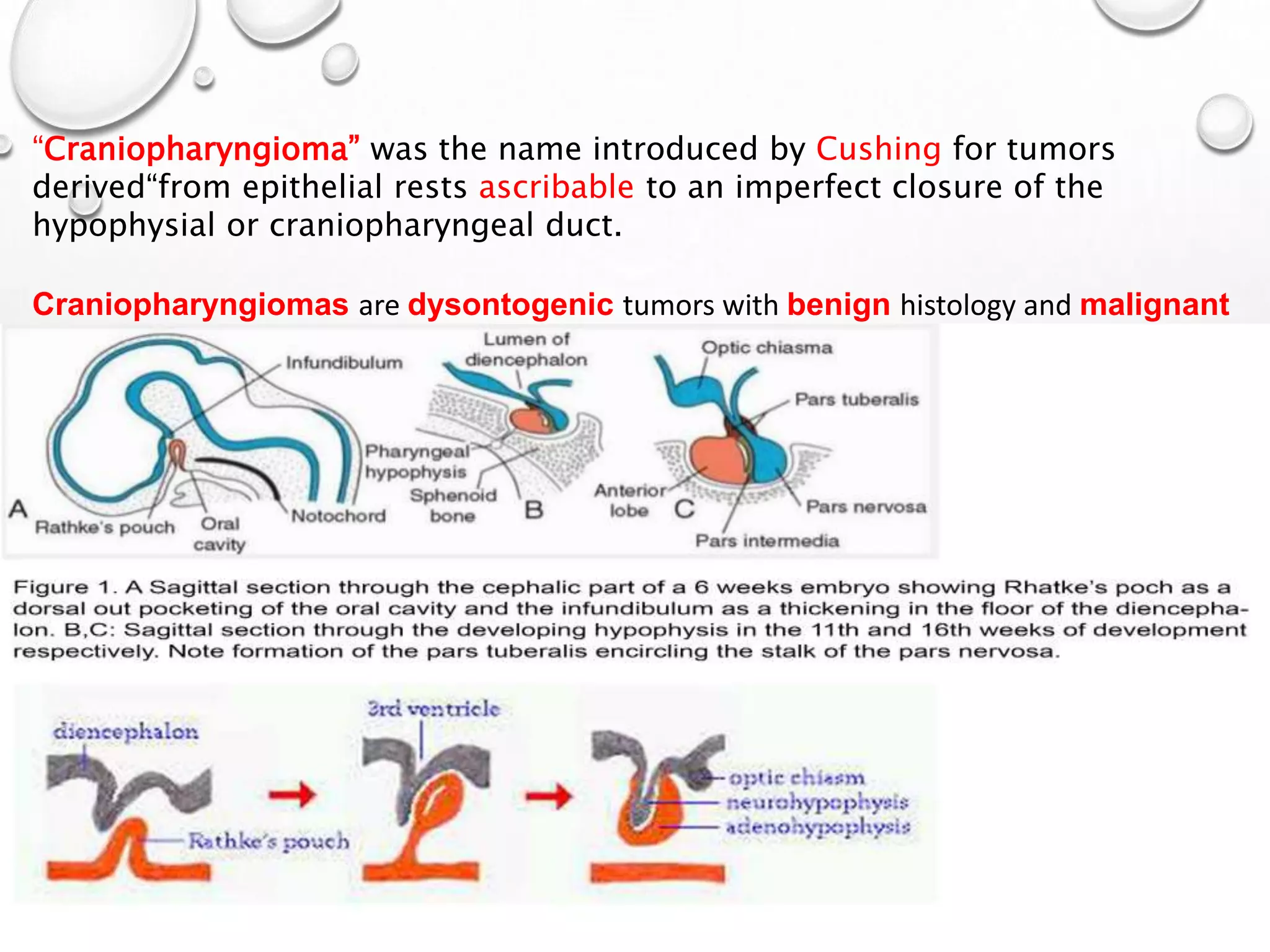 Craniopharyngioma: A case report | PPTX
