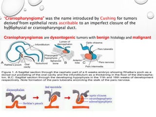Craniopharyngioma: A case report | PPTX