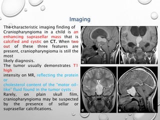 Craniopharyngioma: A case report | PPTX