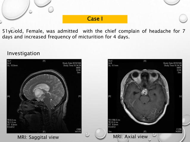 Craniopharyngioma: A case report | PPTX