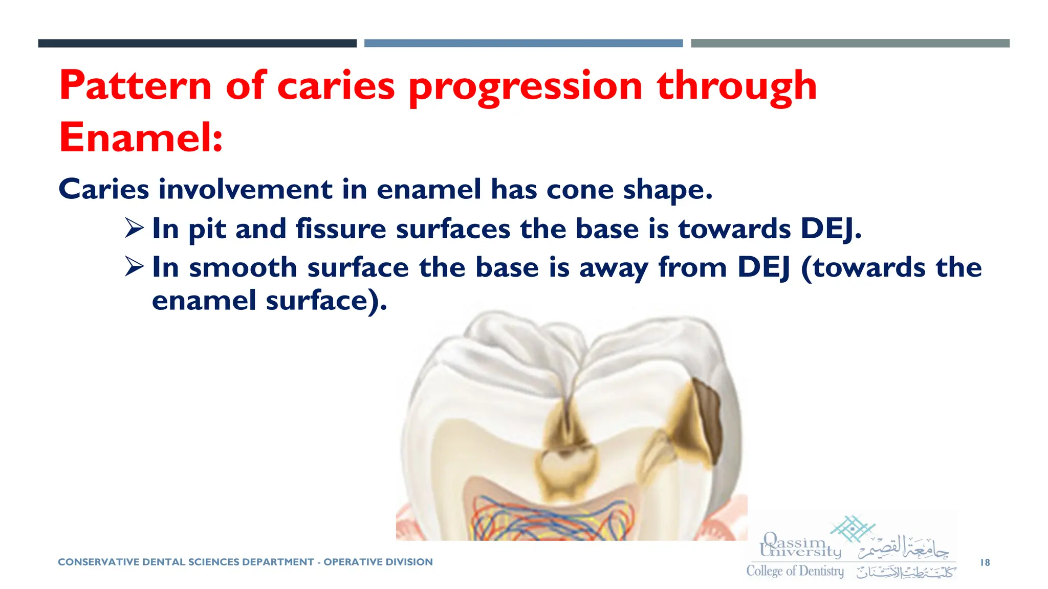 1-1 Dental Caries, Classifications and terminology of cavities.pdf