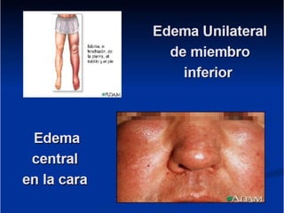 1-1 Edema.ppt