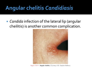 1.1 oral candidiasis | PPTX