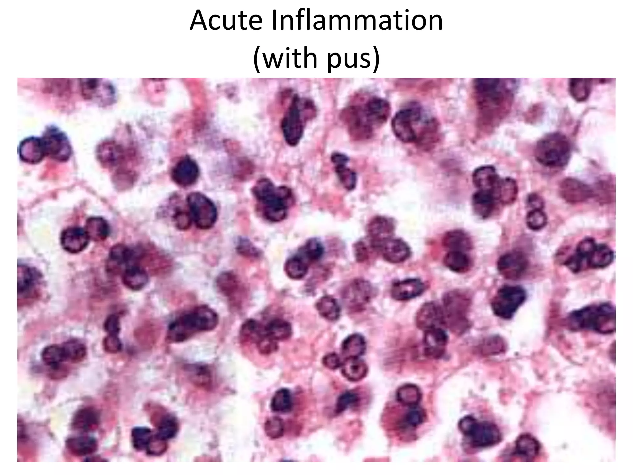 1.Acute Inflammation | PPTX