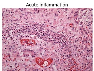 1.Acute Inflammation | PPTX