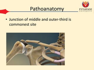 1. Fracture of Clavicle | PPTX