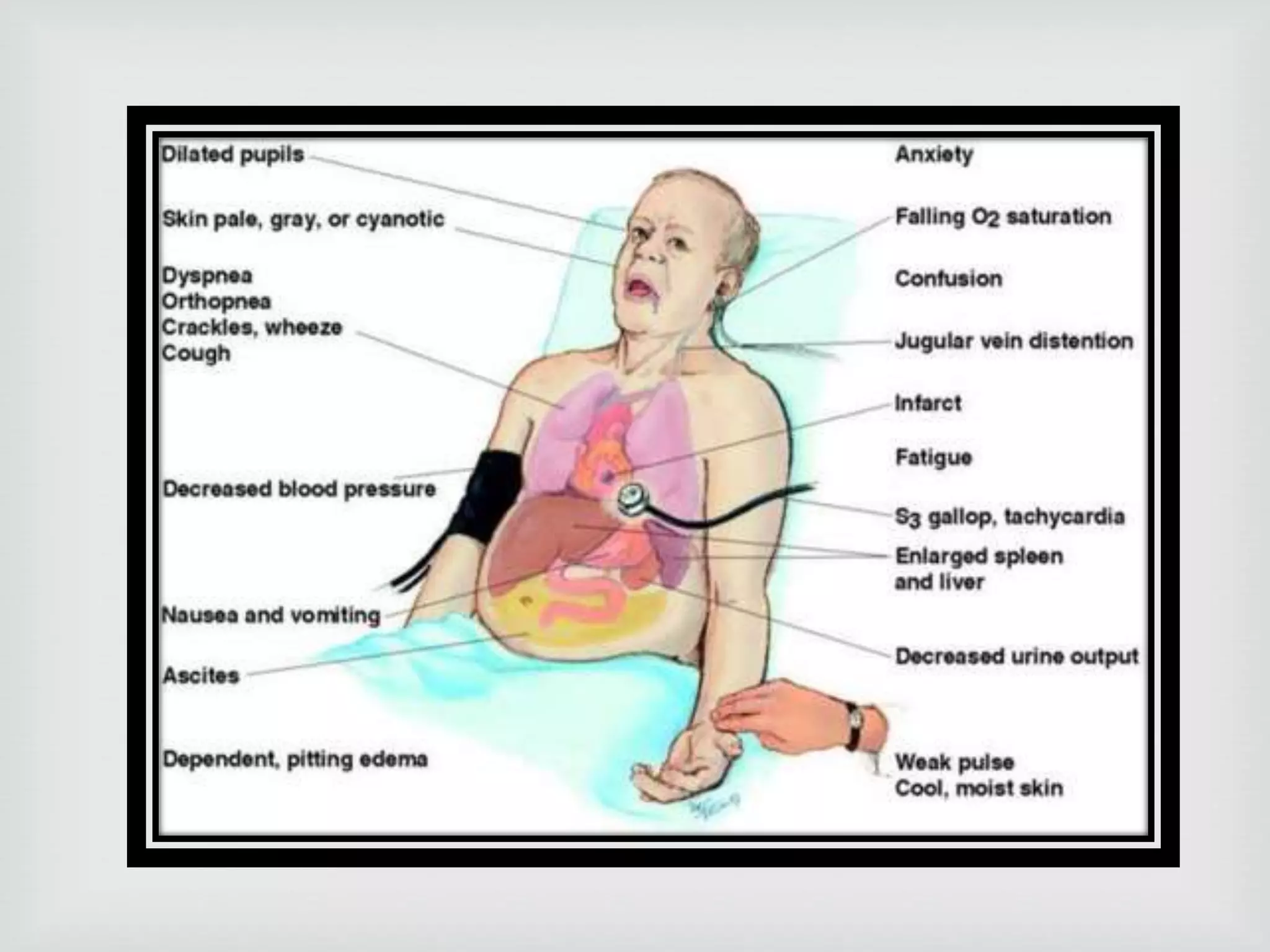 Generalized Anasarca | PPTX