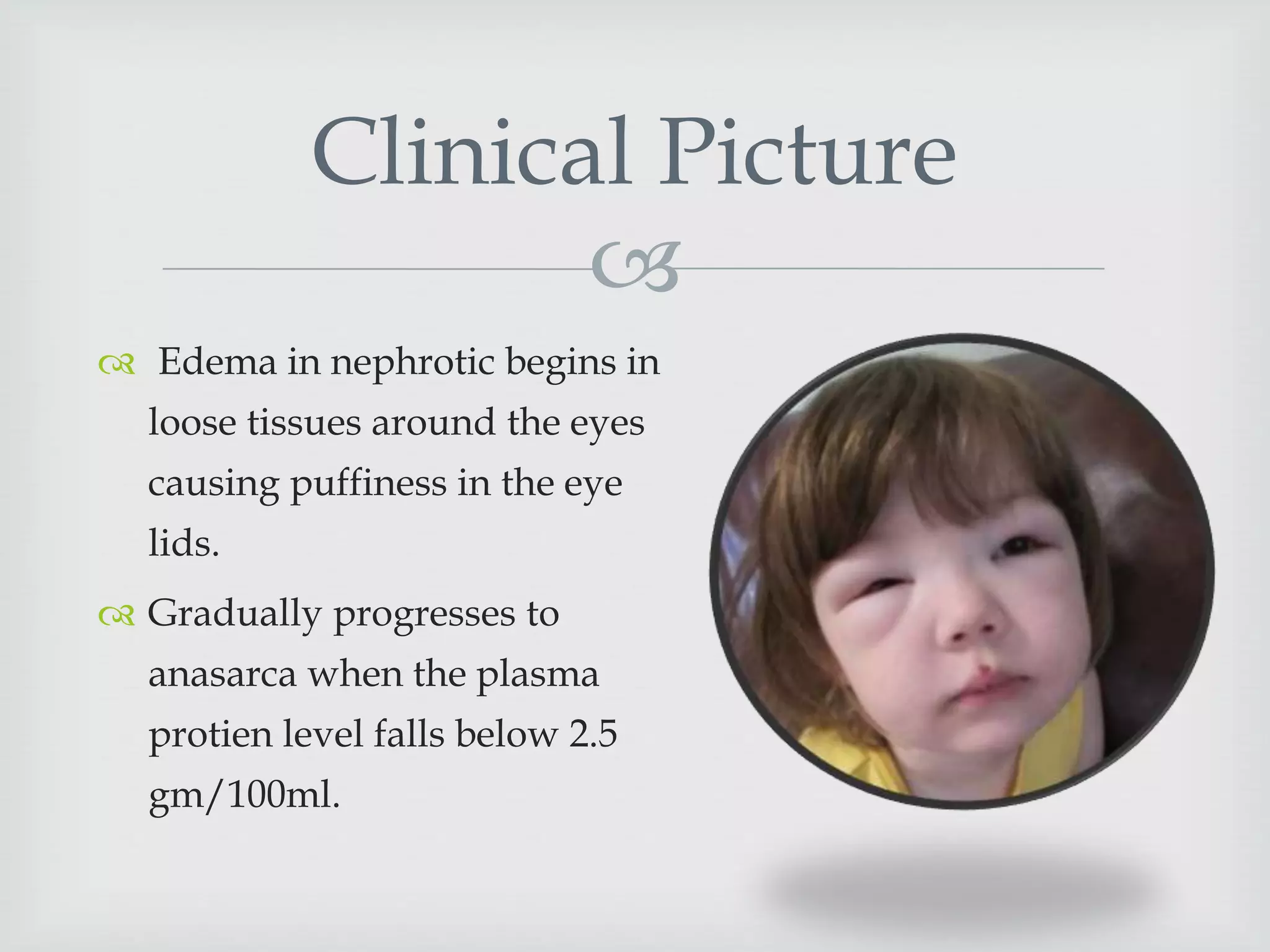 Generalized Anasarca | PPTX