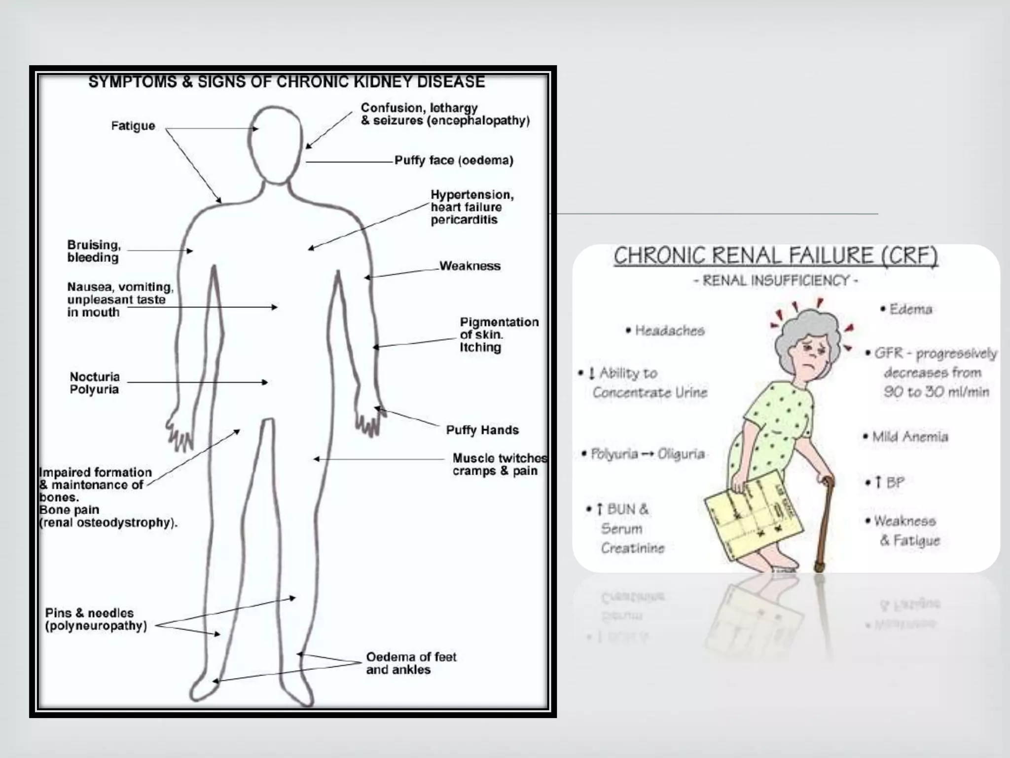 Generalized Anasarca | PPTX