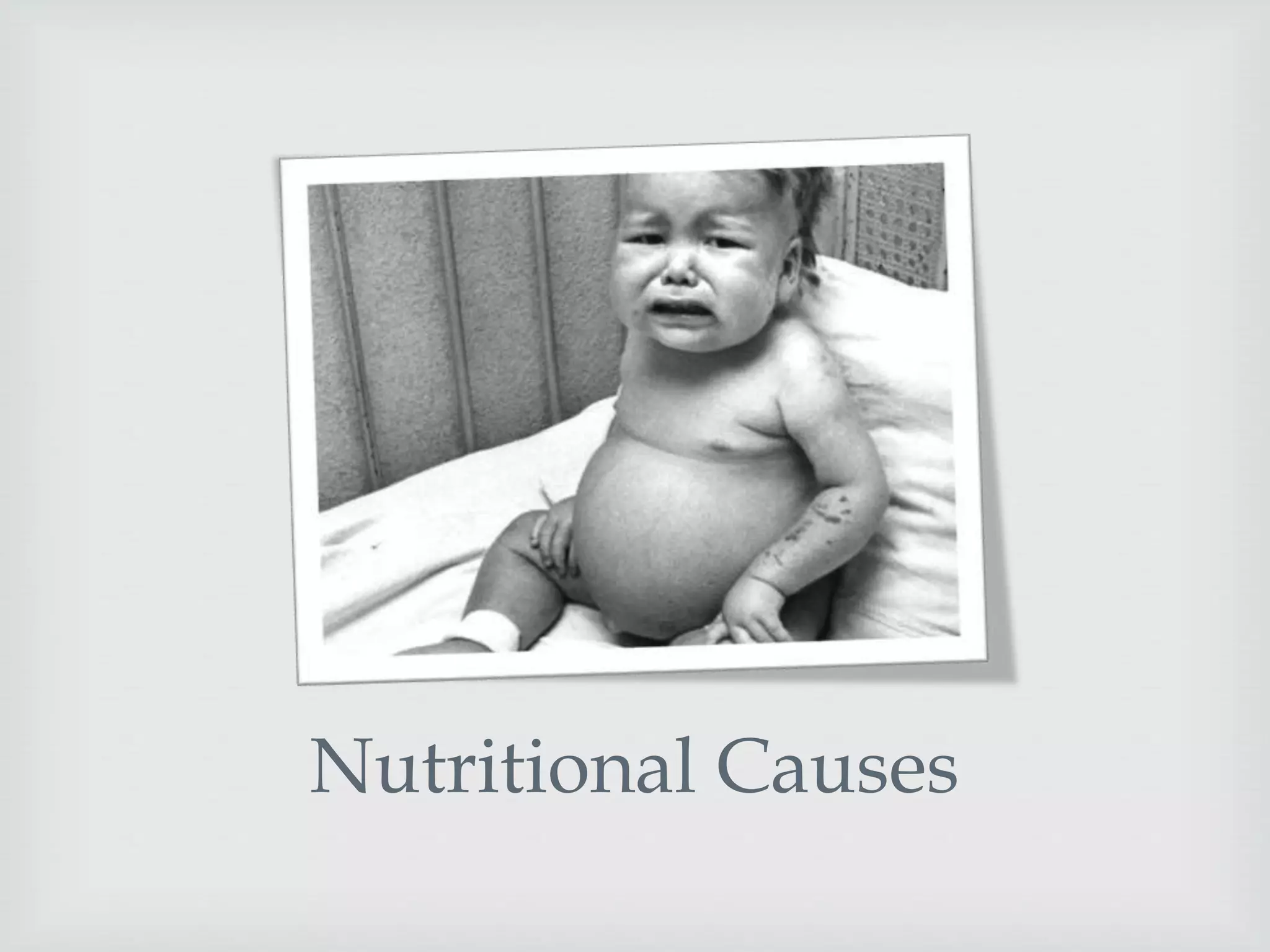 Generalized Anasarca | PPTX