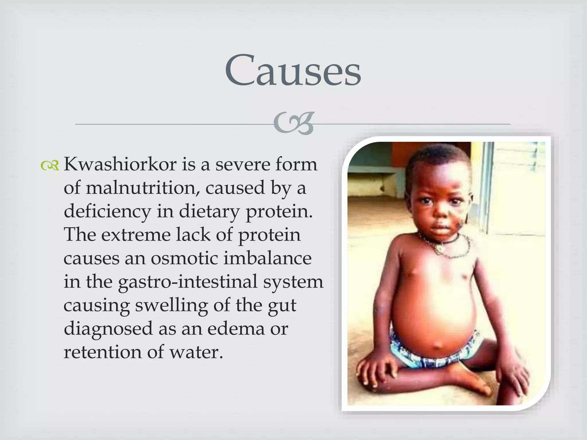 Generalized Anasarca | PPTX