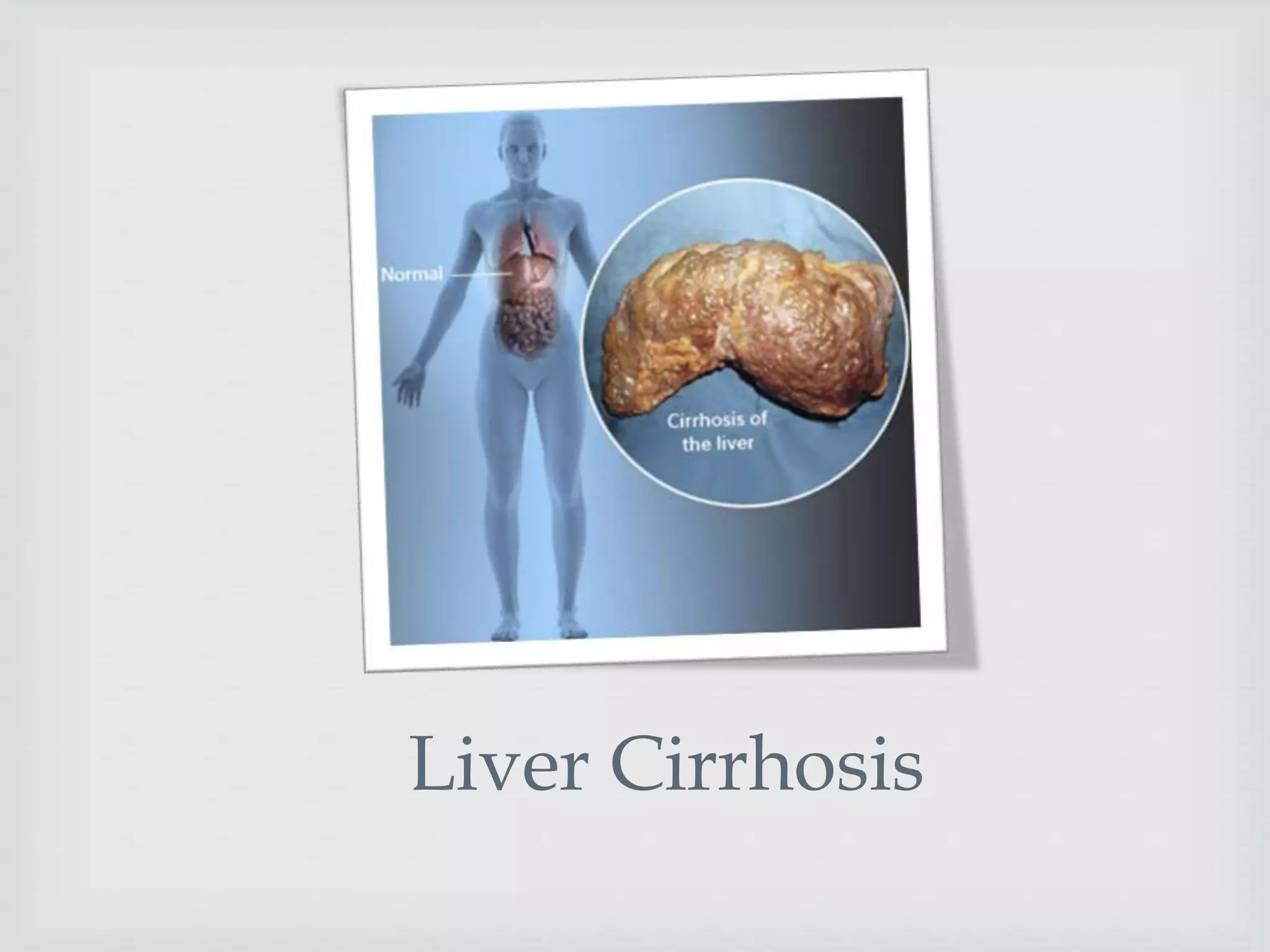 Generalized Anasarca | PPTX