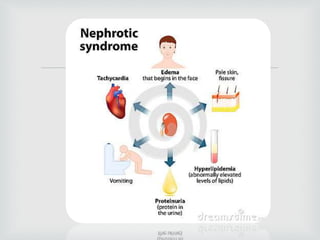 Generalized Anasarca | PPTX