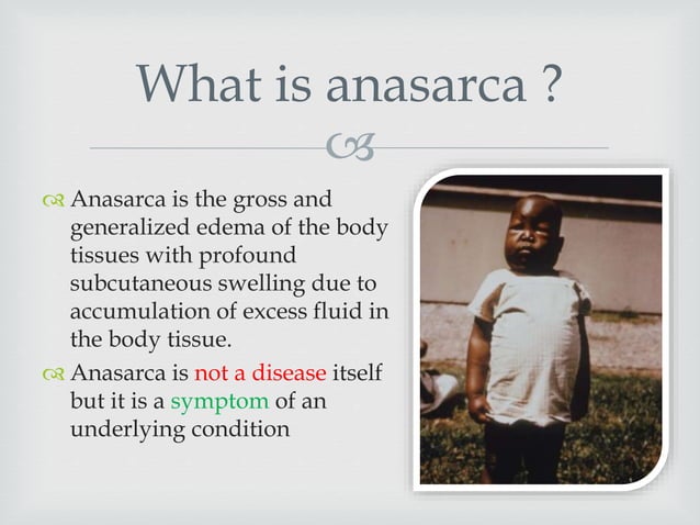 Generalized Anasarca | PPT