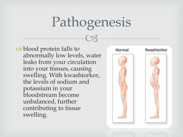 Generalized Anasarca | PPTX