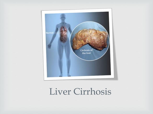 Generalized Anasarca | PPTX
