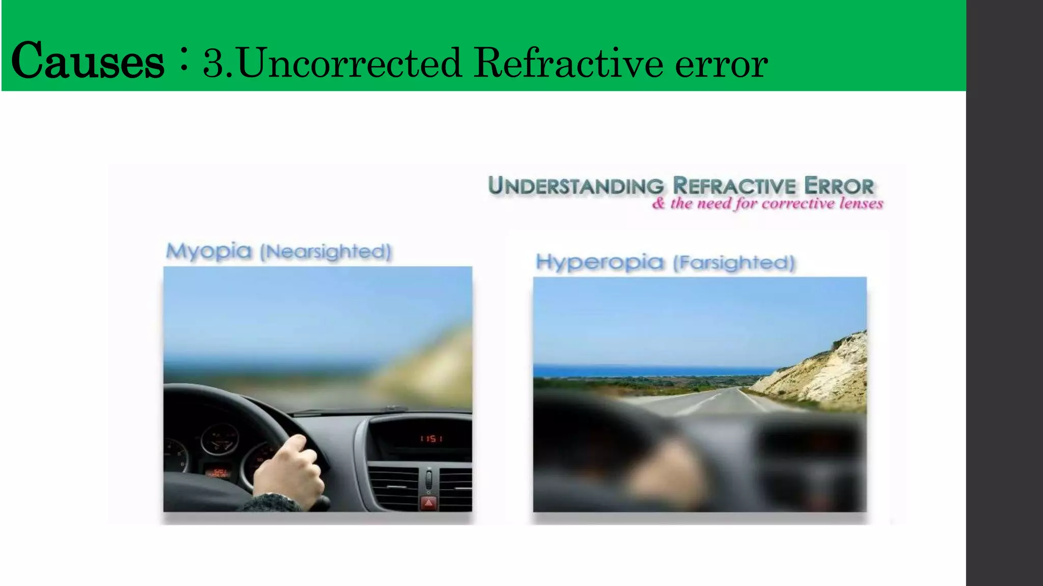 Computer Vision Syndrome | PPTX