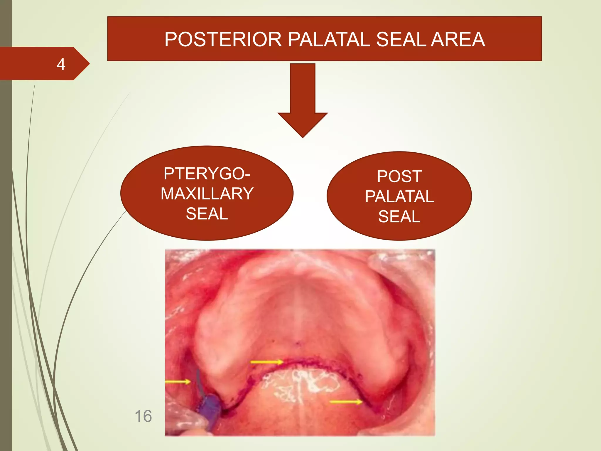 posterior palatal seal | PPTX