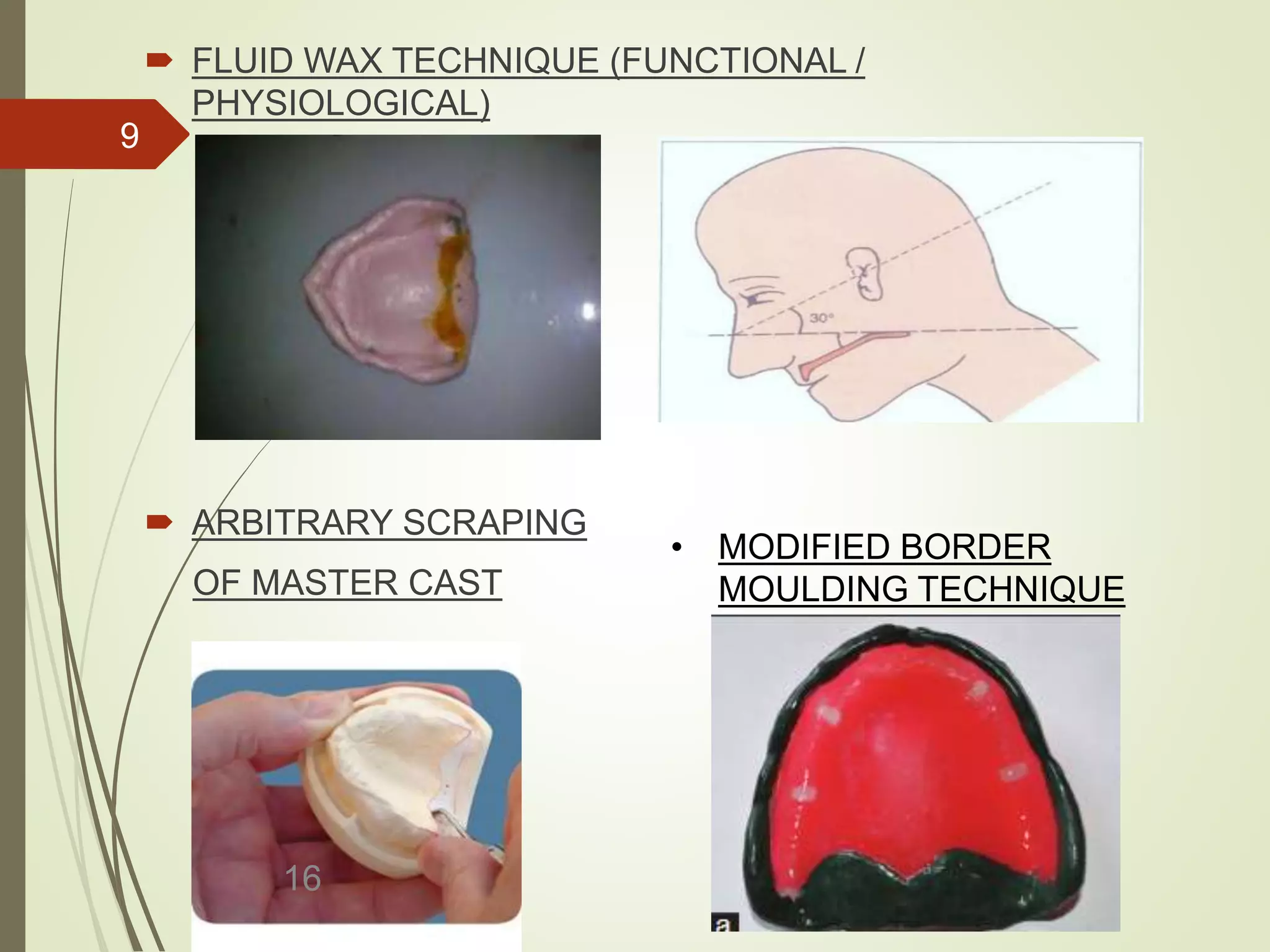 posterior palatal seal | PPTX