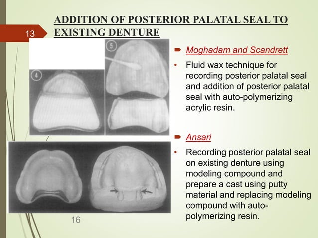 posterior palatal seal | PPTX | Oral care | Personal Care