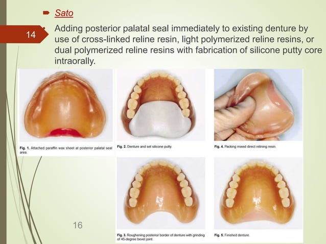 posterior palatal seal | PPTX | Oral care | Personal Care