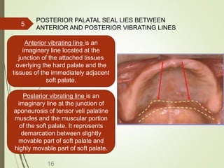 Posterior Palatal Seal