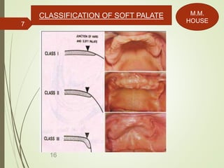 posterior palatal seal | PPTX