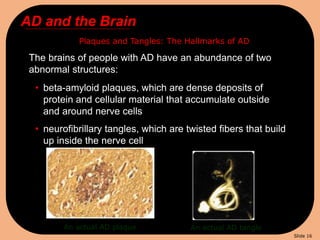 Alzheimers disease and its treatments | PPT