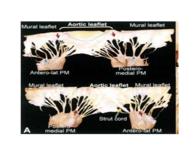 anatomy of mitral valve | PPTX